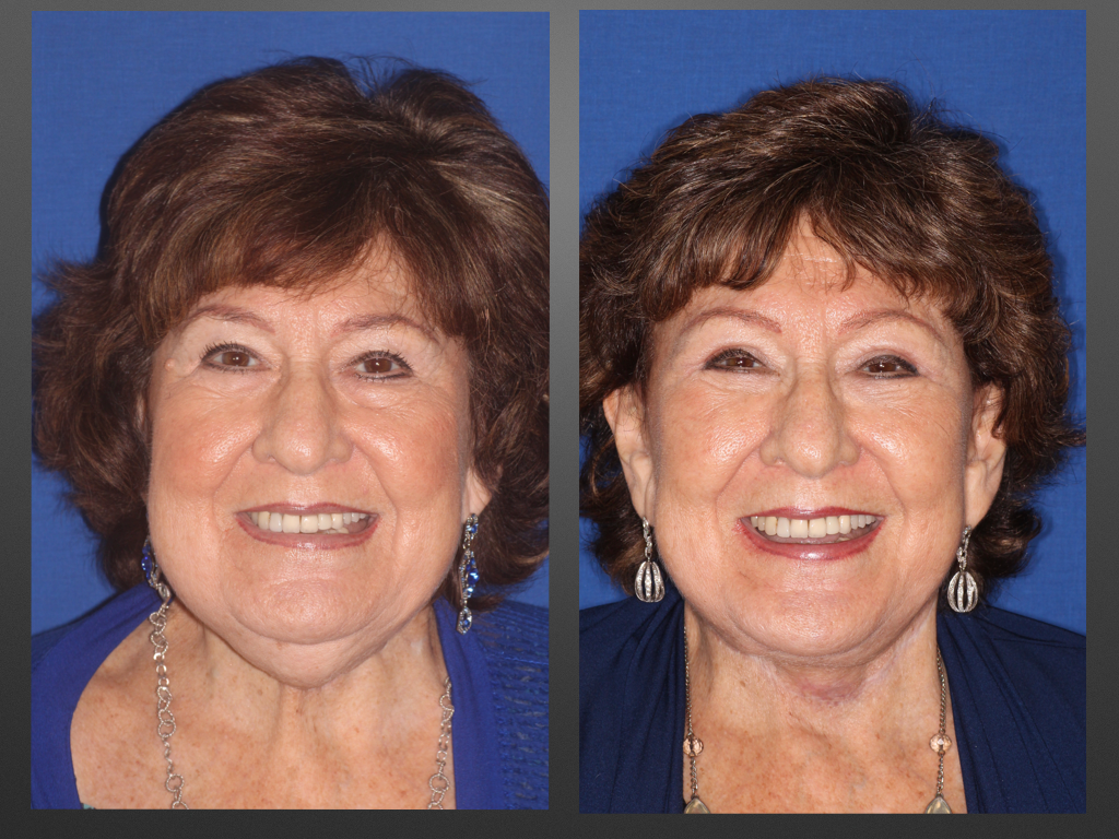 Featured Facial Rejuvenation # 1 Newport News VA, The Aesthetic Face