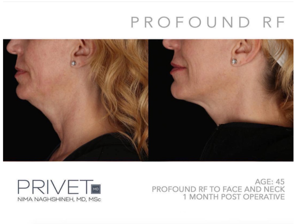Profound RF Facelift Newport News | Profound Lift Hampton VA | Dr. Green