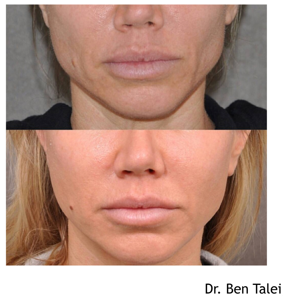 Profound RF Facelift Newport News | Profound Lift Hampton VA | Dr. Green