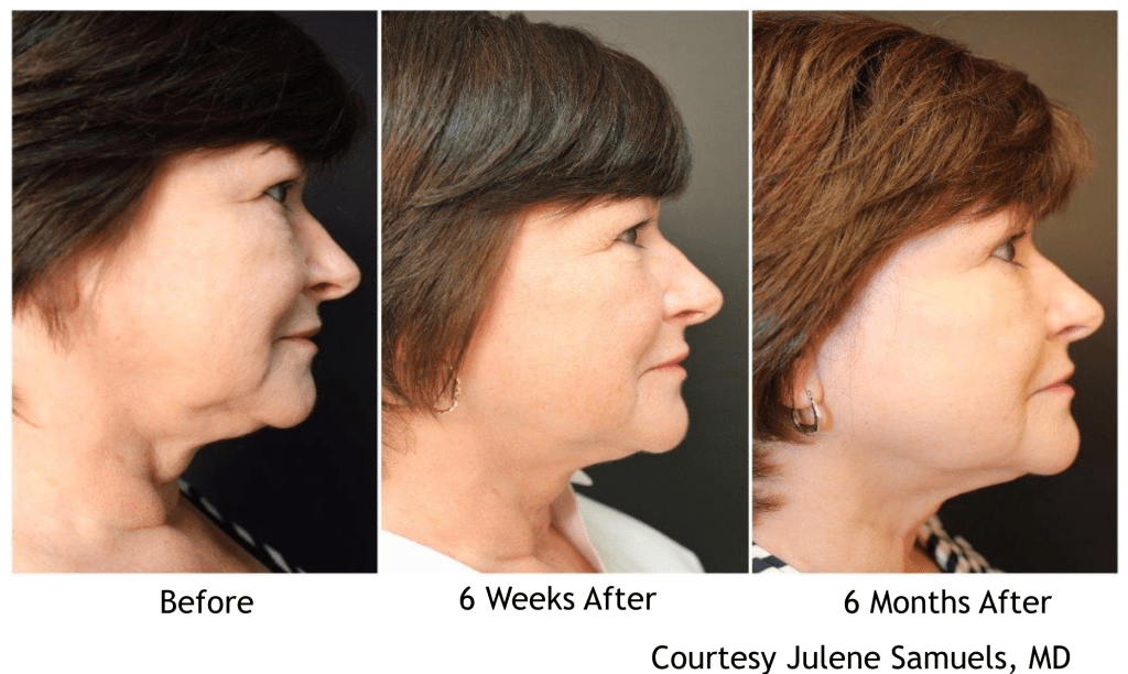 Profound RF Facelift Newport News | Profound Lift Hampton VA | Dr. Green