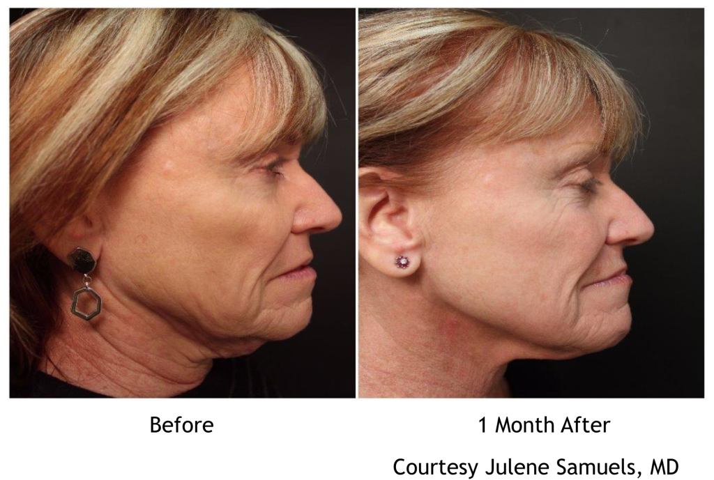 Profound RF Facelift Newport News | Profound Lift Hampton VA | Dr. Green