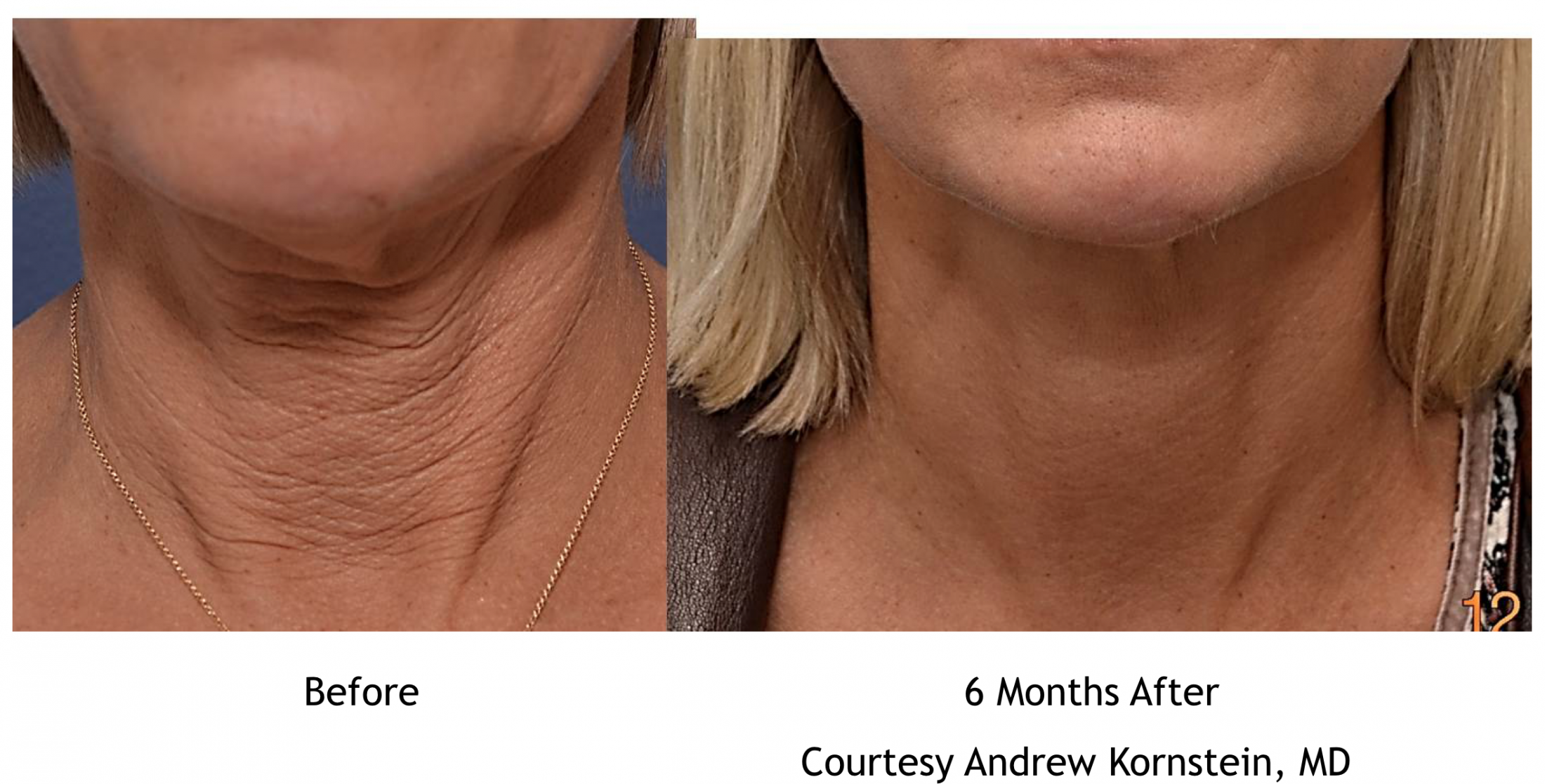 Profound RF Facelift Newport News | Profound Lift Hampton VA | Dr. Green