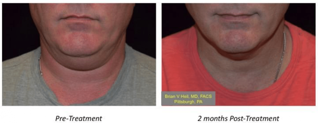 Profound RF Facelift Newport News | Profound Lift Hampton VA | Dr. Green
