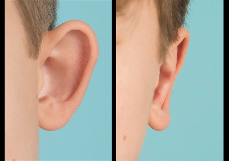 Otoplasty and Ear Tucks Newport News VA, The Aesthetic Face