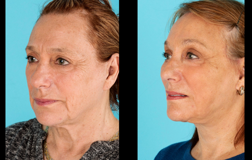 Cheek Implants Newport News VA | Cheek Augmentation | Cosmetic Cheek ...